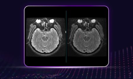 벌써 6번째…제이엘케이, MRI 기반 AI 솔루션 'JLK-GRE' 日 허가 획득 : zum 뉴스