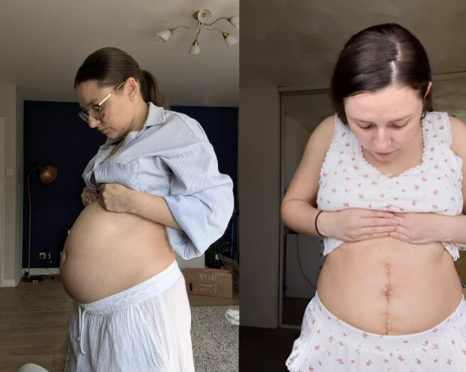 "20대 여성 거대한 배 무슨일이"…'7kg 낭종' 발견 [헬스톡] : zum 뉴스