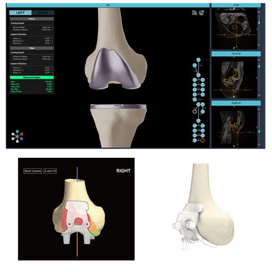 스카이브 KNEEVIGATE, MRI 연골 분석 활용한 맞춤형 수술 기구 구현 : zum 뉴스