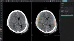 제이엘케이, 뇌졸중 AI 솔루션 'JLK-ICH' FDA 인허가 획득 : ZUM 뉴스