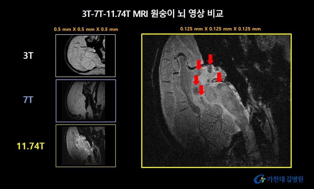 가천대 길병원, "세계 최초 11.74T MRI 이용한 원숭이 뇌 영상 획득 성공" : zum 뉴스